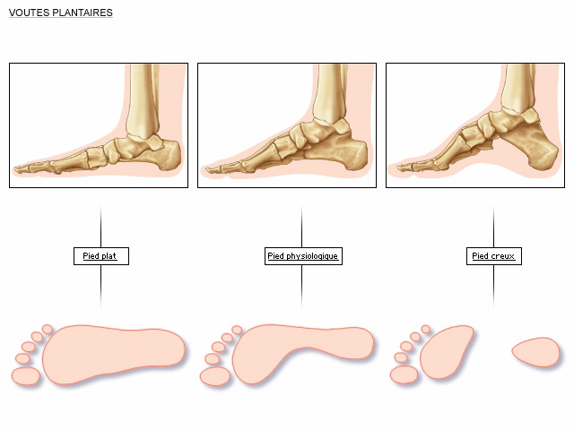 Autres pathologies du pied - Chirurgie pied
